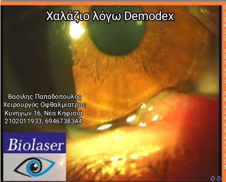 Το Demodex κύρια αιτία των χαλαζίων – ΠΡΟΤΥΠΟ ΚΕΝΤΡΟ ΘΕΡΑΠΕΙΑΣ DEMODEX ...